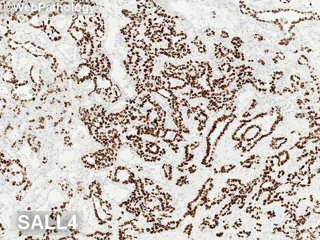 Yolk Sac Tumor : Immunostains - SALL4