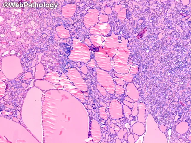 Struma Ovarii : Introduction