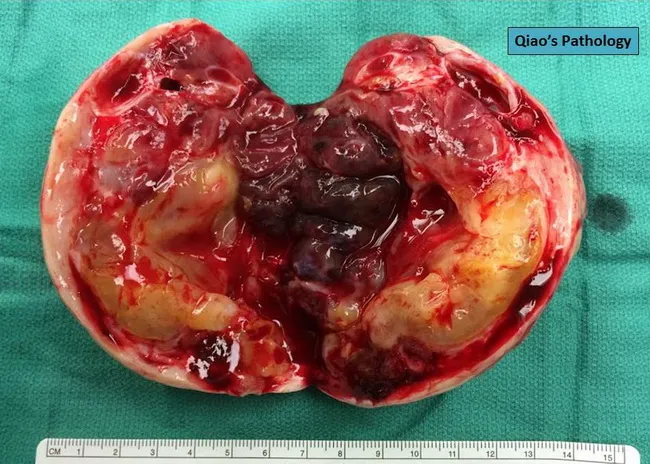 Struma Ovarii : Clinical & Gross Features