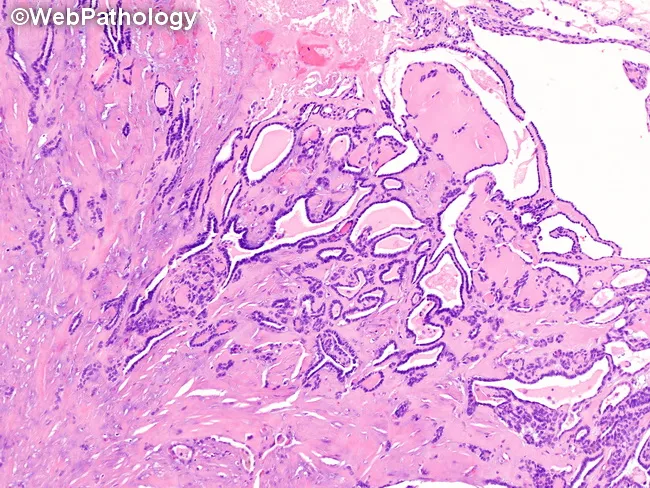 Struma Ovarii : Differential Diagnosis