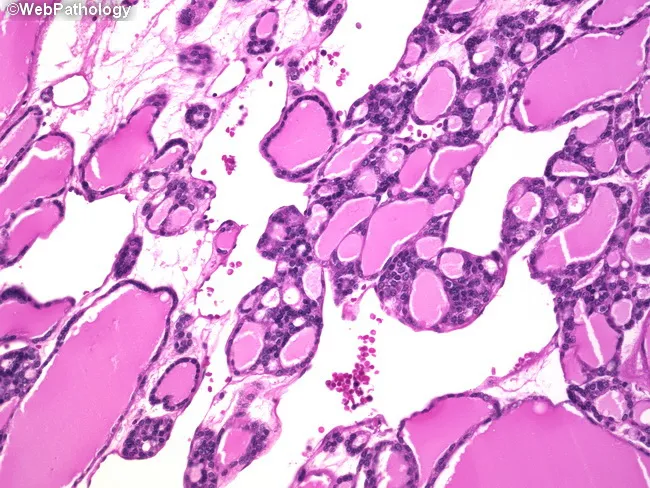 Struma Ovarii : Treatment & Prognosis