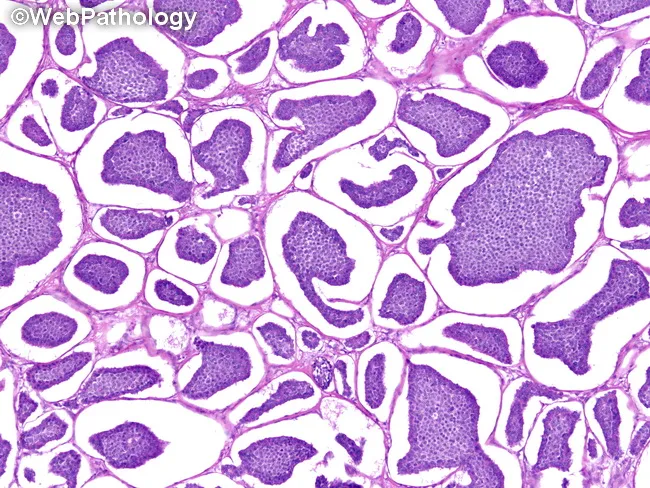 Ovarian Carcinoid : Insular Pattern