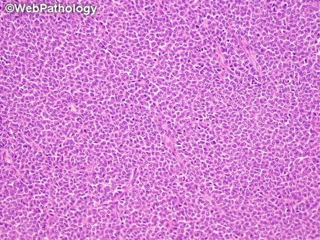 Adult Granulosa Cell Tumor : Diffuse Pattern