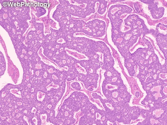 Adult Granulosa Cell Tumor : Microfollicular Pattern