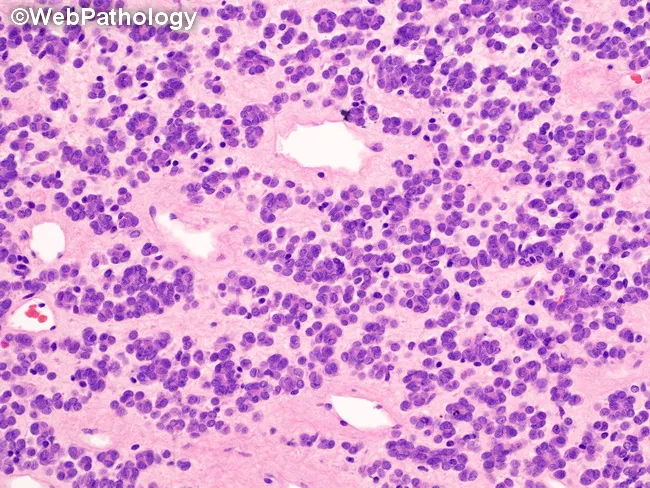Metanephric Adenoma : Microscopic Features