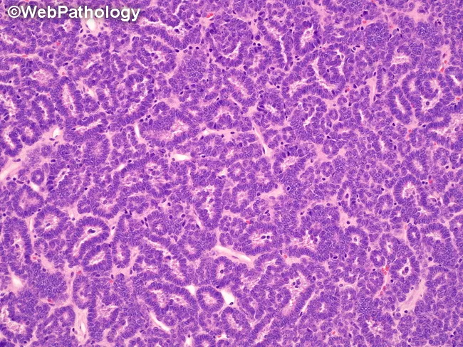 Metanephric Adenoma : Microscopic Features
