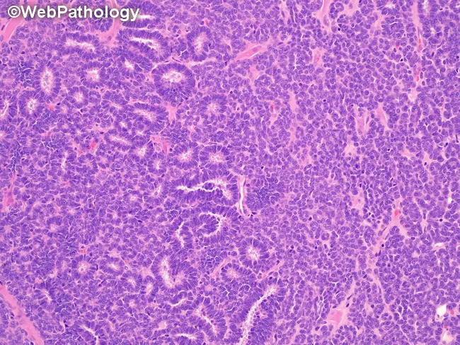 Metanephric Adenoma : Microscopic Features