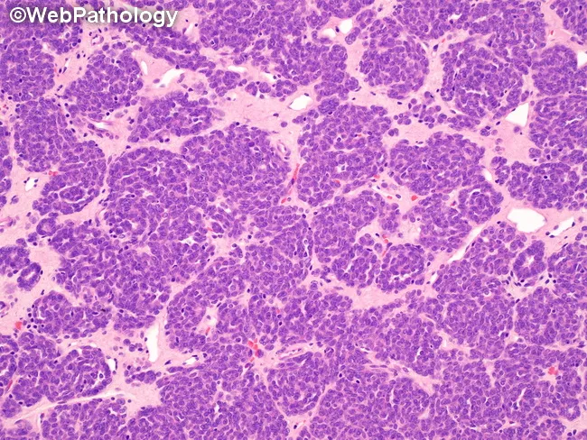 Metanephric Adenoma : Microscopic Features