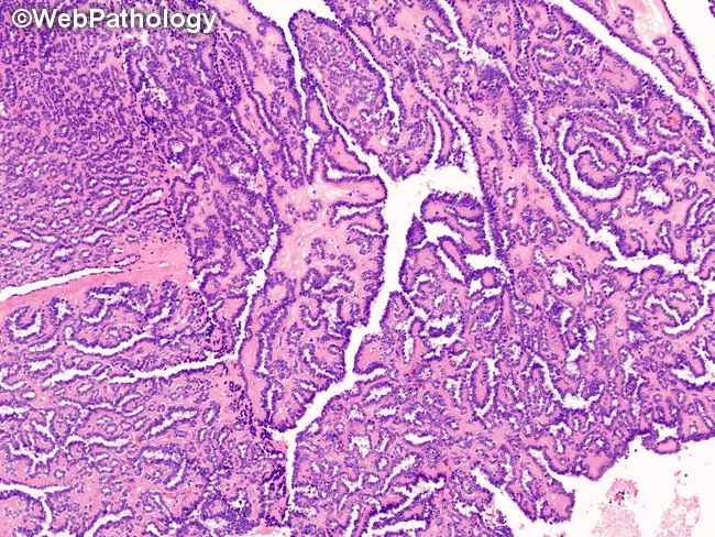 Metanephric Adenoma : Microscopic Features