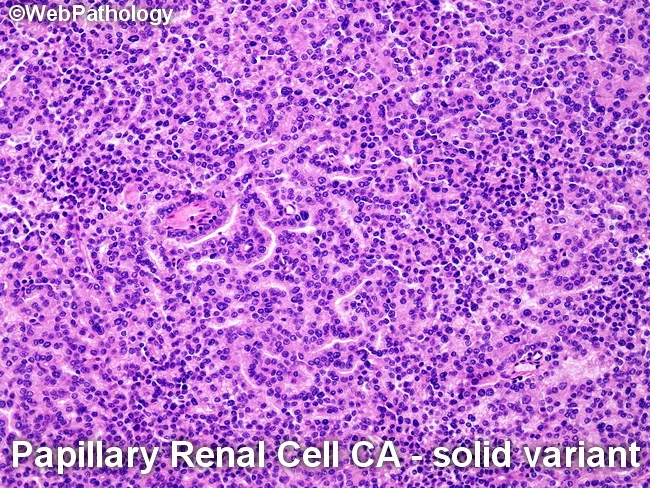 Metanephric Adenoma : Differential