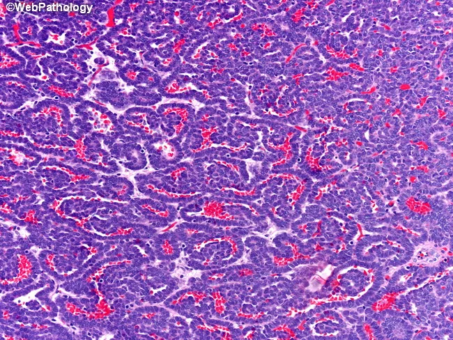 Metanephric Adenoma Pathology Outlines