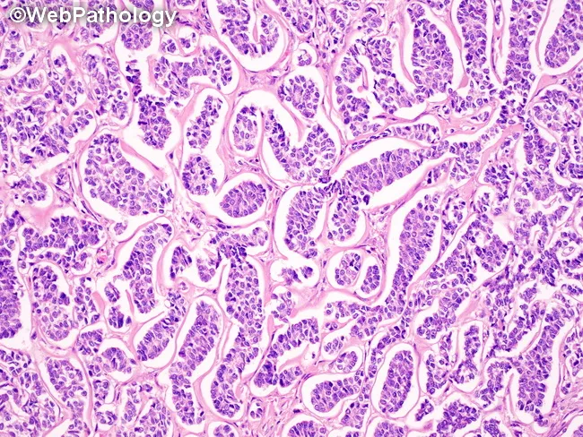Adult Granulosa Cell Tumor : Nested Pattern