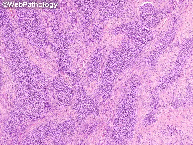 Adult Granulosa Cell Tumor : Nested Pattern