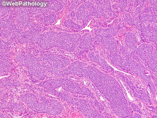 Adult Granulosa Cell Tumor : Nested Pattern