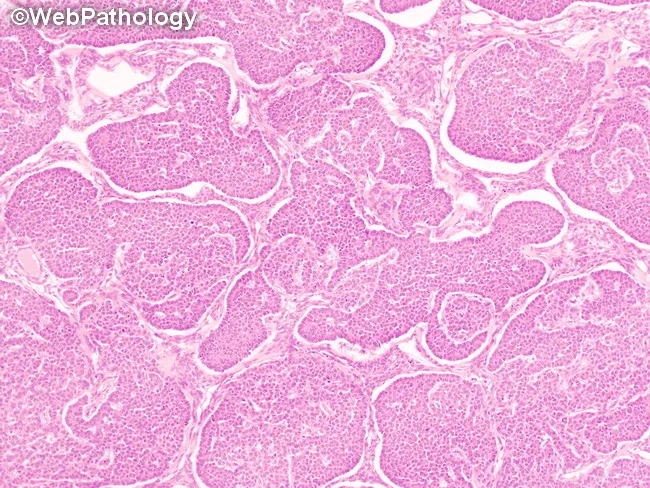 Adult Granulosa Cell Tumor : Nested Pattern
