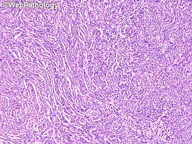 Adult Granulosa Cell Tumor : Gyriform Pattern