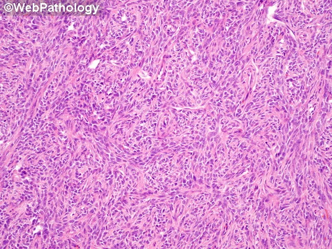 Adult Granulosa Cell Tumor : Sarcomatoid Pattern