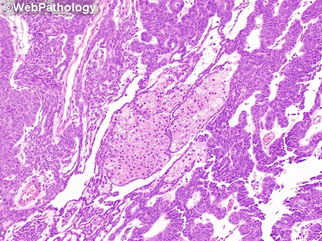 Luteinized Adult Granulosa Cell Tumor