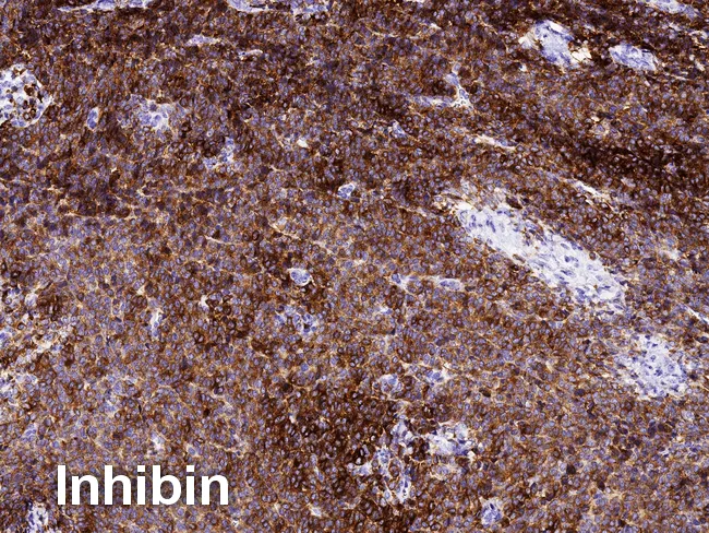 Adult Granulosa Cell Tumor : Immunostains - Inhibin
