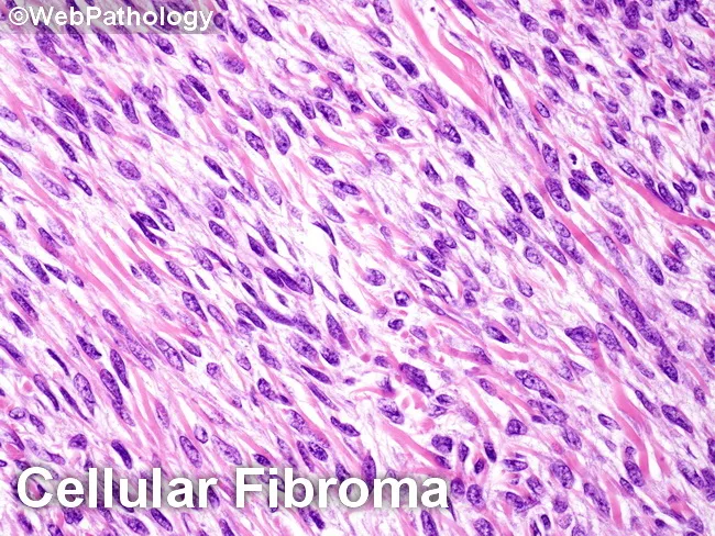 Adult Granulosa Cell Tumor : Differential