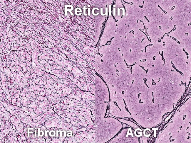 Adult Granulosa Cell Tumor : Differential