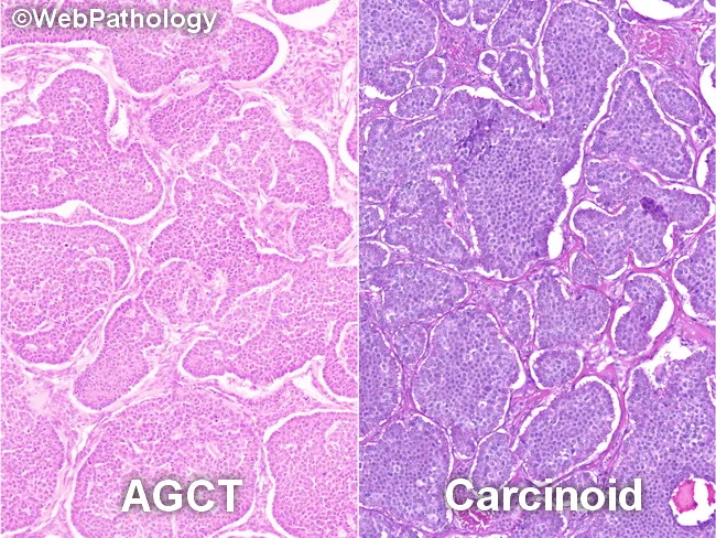 Adult Granulosa Cell Tumor : Differential