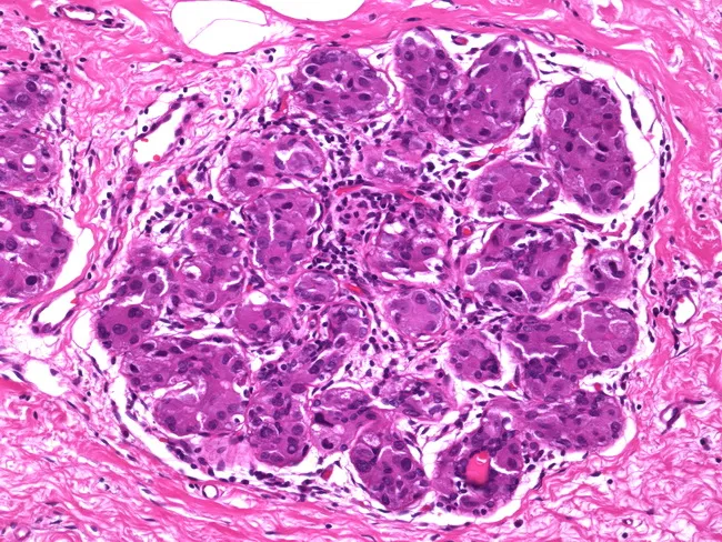 Apocrine CA : Lobular cancerization