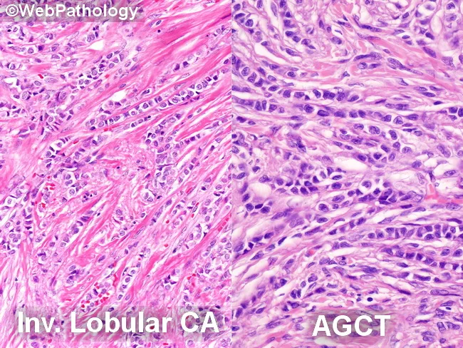 Adult Granulosa Cell Tumor : Differential