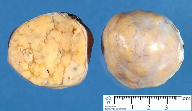 Juvenile Granulosa Cell Tumor