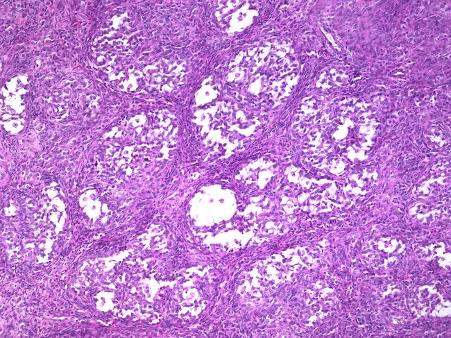 Juvenile Granulosa Cell Tumor