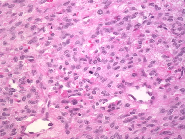 Fibrosarcoma of the Ovary