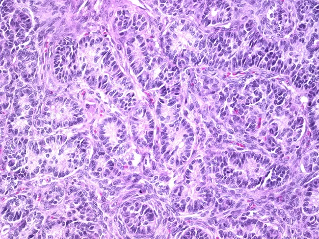 Sertoli-Leydig Cell Tumor : Well-differentiated