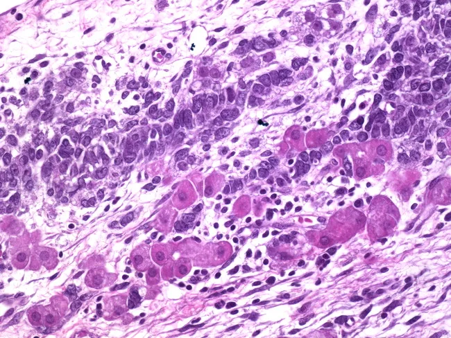 Sertoli-Leydig Cell Tumor : Well-differentiated