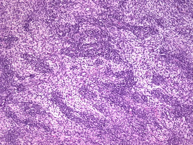 Leydig Cell Tumour Histology