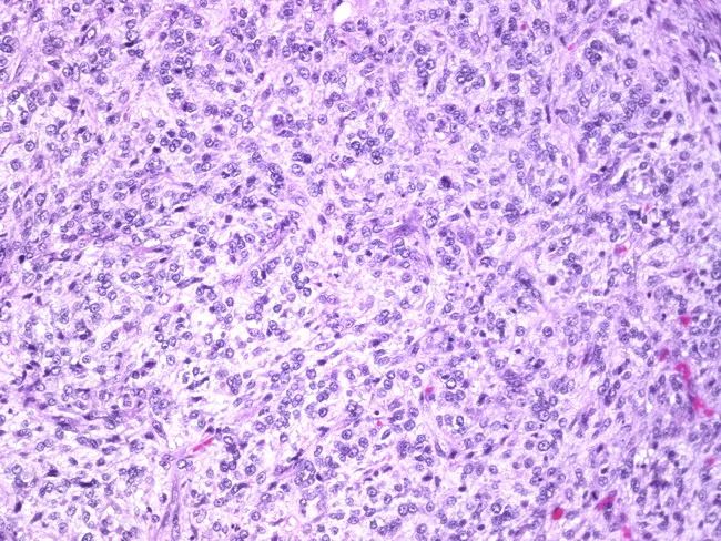 Sertoli-Leydig Cell Tumor : Poorly-differentiated