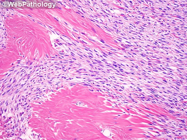 Ovarian Fibroma : Microscopic Features