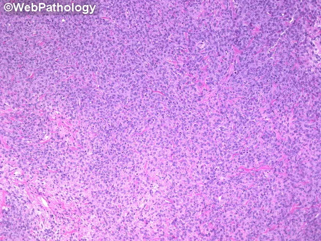 Ovary : Cellular Fibroma