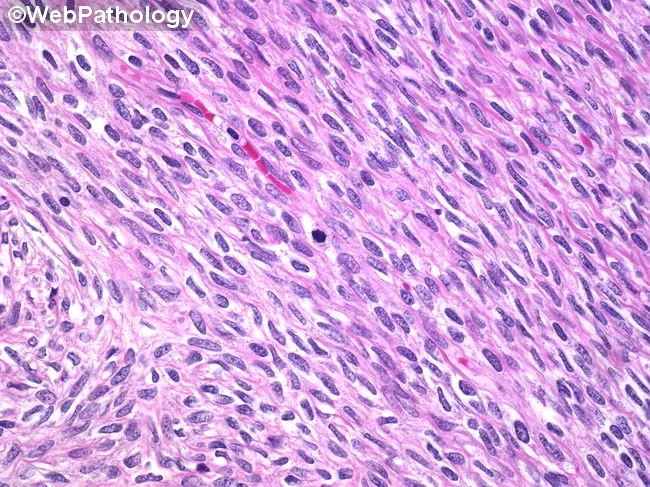 Ovary : Cellular Fibroma