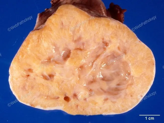 Thecoma : Introduction & Clinical