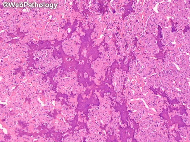 Thecoma : Calcification