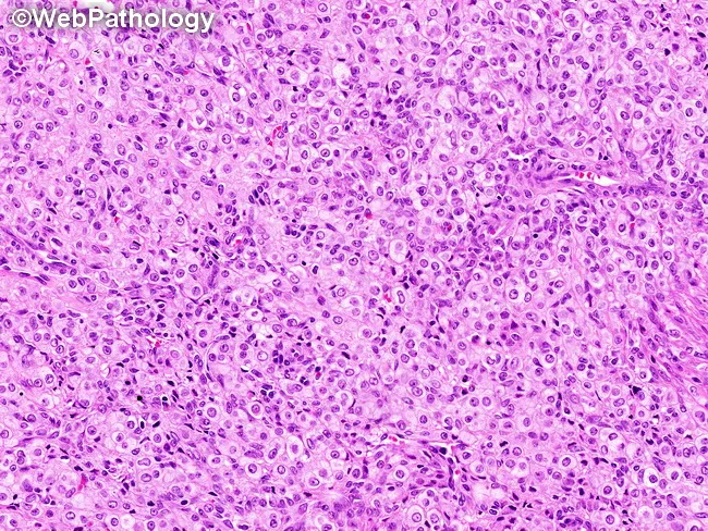 Thecoma : Differential Diagnosis