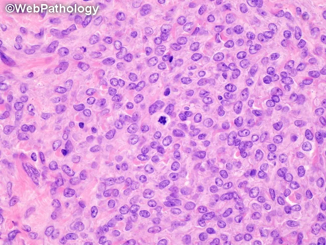 Thecoma : Differential Diagnosis