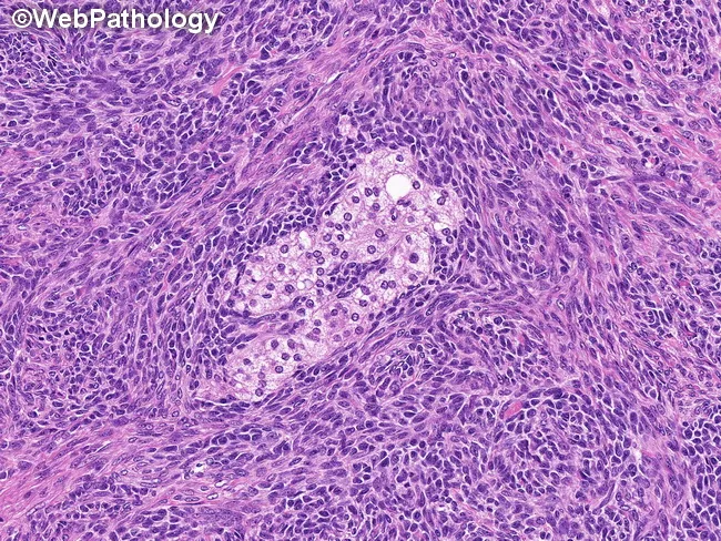 Luteinized Thecoma : Introduction