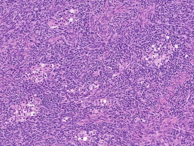 Luteinized Thecoma : Clinical Features