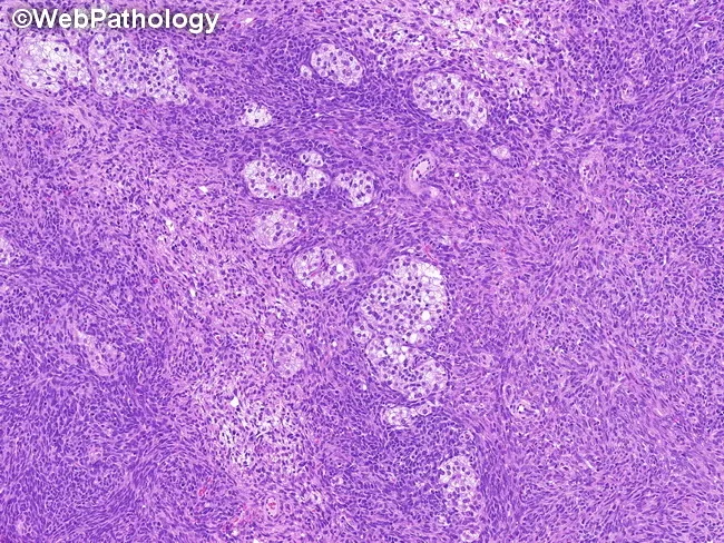 Luteinized Thecoma : Gross & Micro