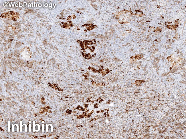 Luteinized Thecoma : Differential & Treatment