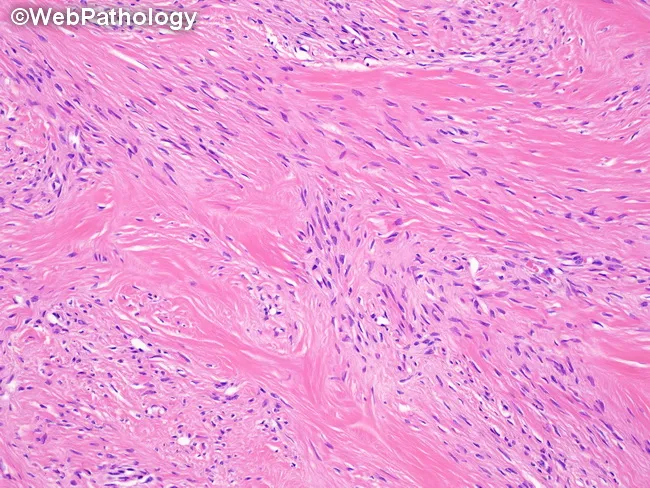 Fibrothecoma