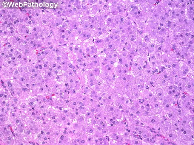 Steroid Cell Tumor, NOS : Introduction