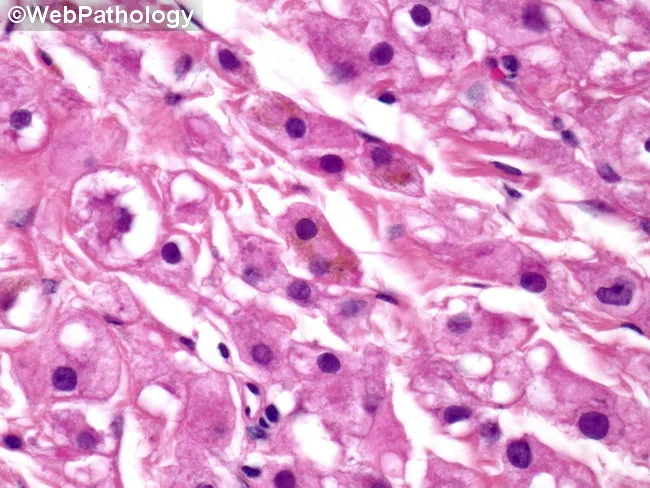Steroid Cell Tumor, NOS : Lipochrome Pigment