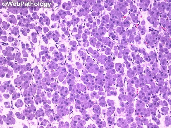 Steroid Cell Tumor, NOS : Microscopic